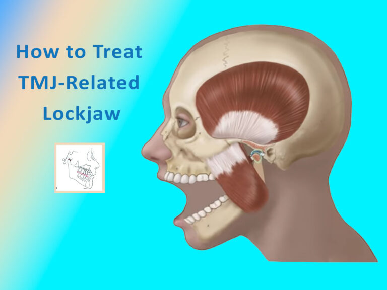 What is Lock Jaw? - Minnesota Neck and Pain Clinic